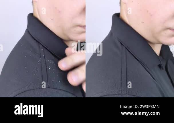 Dandruff before and after. The man on the left shows his shoulder ...