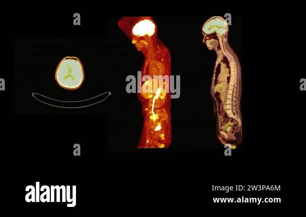 Collection PET CT ( Positron Emission Tomography ) of whole human body ...
