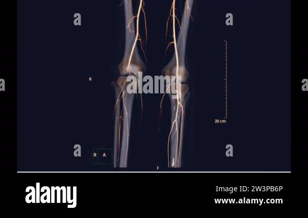 CTA femoral artery run off 3D rendering image of lower Extremity ...