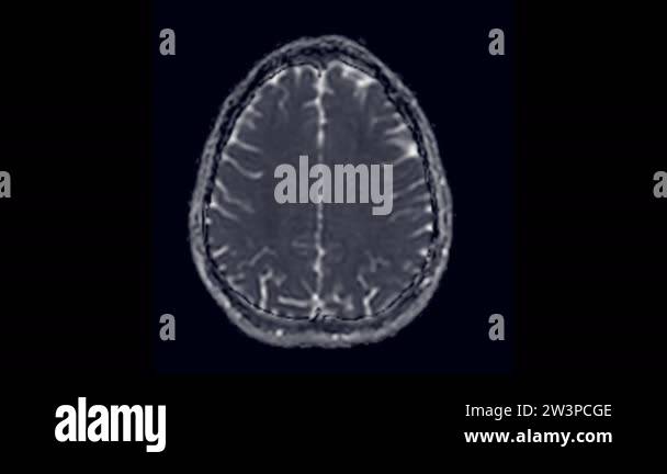 MRI brain or magnetic resonance imaging of the brain in Axial ADC or ...