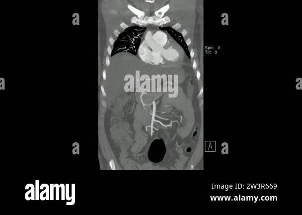Computed Tomography of the Aorta from the chest to the pelvis in ...