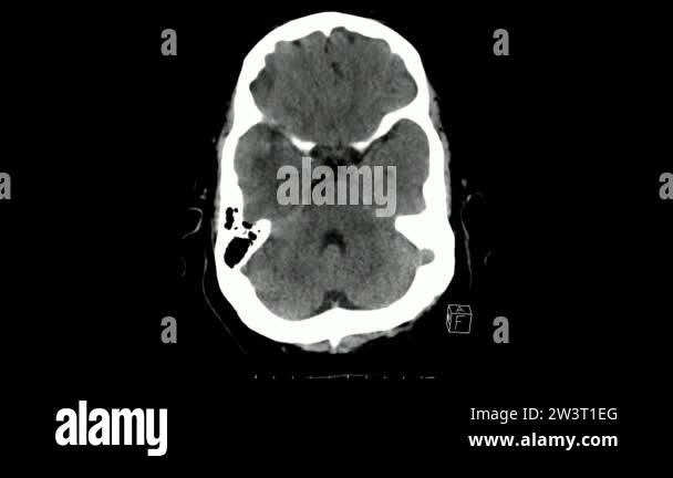 Computed tomography scan of the brain axial cuts showing massive right ...