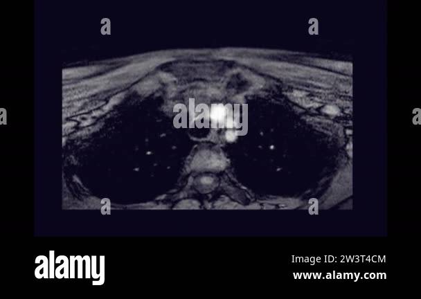 MRA carotid artery Axial view technique Time-of-Flight (TOF) showing ...