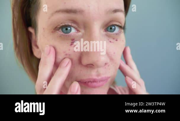 Woman bruises face Stock Videos & Footage - HD and 4K Video Clips - Alamy