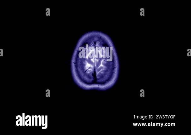Time lapse of MRI brain scan, timelapse of blue magnetic resonance ...