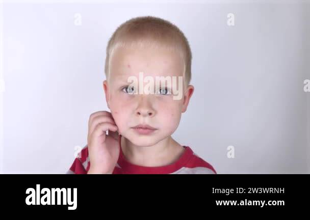 Measles rash face Stock Videos & Footage - HD and 4K Video Clips - Alamy