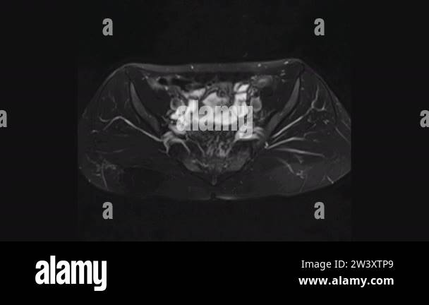 MRI of the female pelvic organs, abdominal cavity, gastrointestinal ...