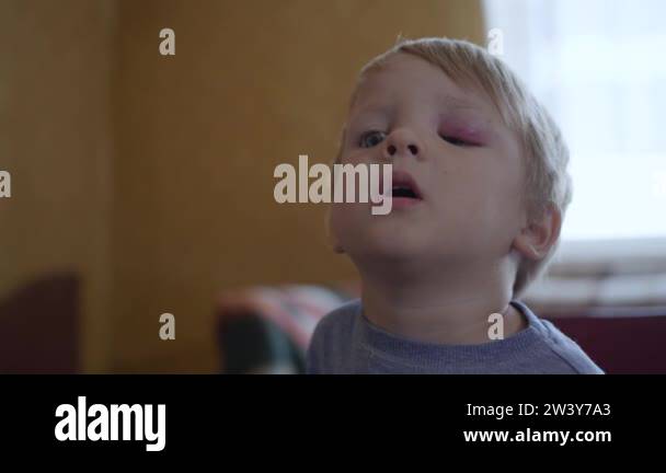 small male child with an injury or a bruise on his face cannot open his ...