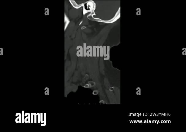 Radiology examination, Computed Tomography examination of the Cervical ...