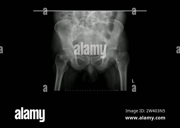 X -Ray of the pelvis showing left femur neck fracture ( X-Ray Pelvis ...