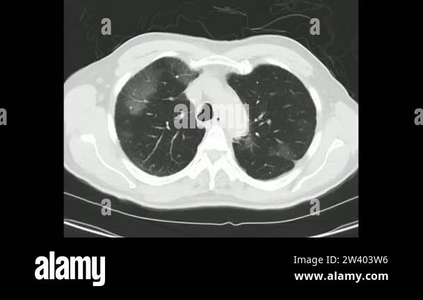 High resolution ct chest Stock Videos & Footage - HD and 4K Video Clips ...