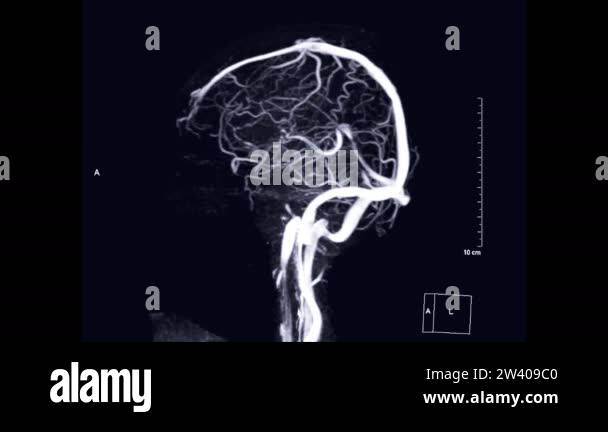 MRV Brain or magnetic resonance venography of The Brain 3D mip view ...