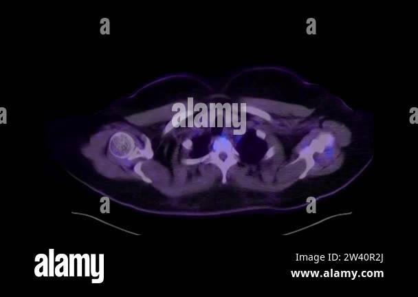 PET CT Scan of whole body from head to toe with fusion technique mix CT ...