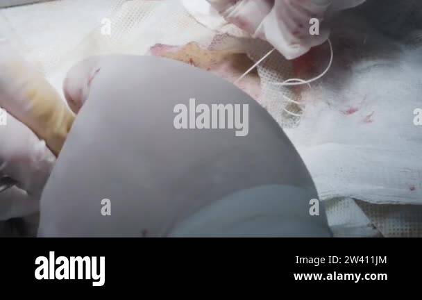 Surgical suture tying. Action. Professional surgeons tie stitches with ...