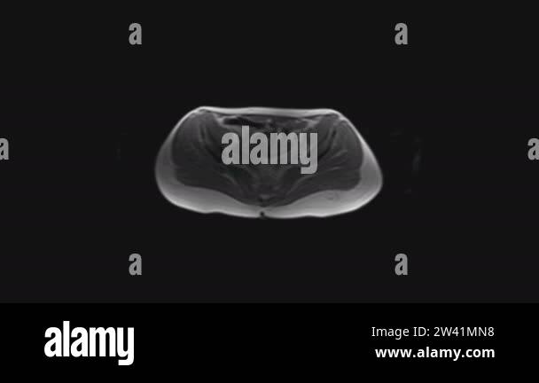 MRI of the female pelvic organs, abdominal cavity, gastrointestinal ...