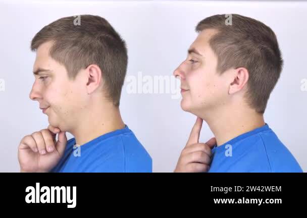 Second chin lift in man. Photos before and after plastic surgery ...