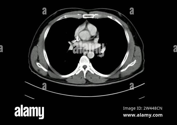 Computed Tomography scan (CT scan) of the chest, Abdomen and pelvis ...