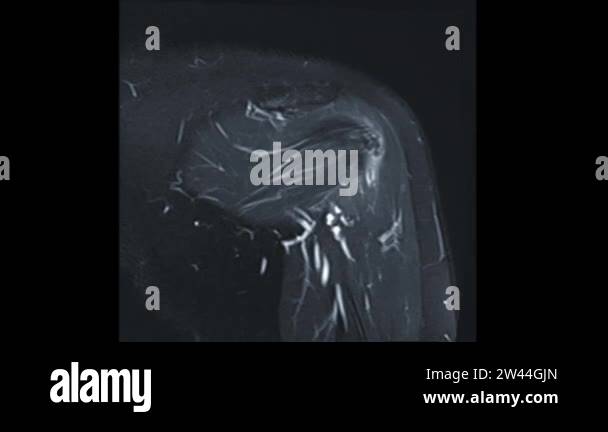 Compare MRI Shoulder joint or Magnetic resonance imaging of Shoulder ...