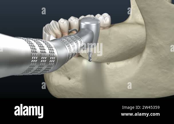 Cleavage of the alveolar ridge, augmentation, implantation. Dental ...