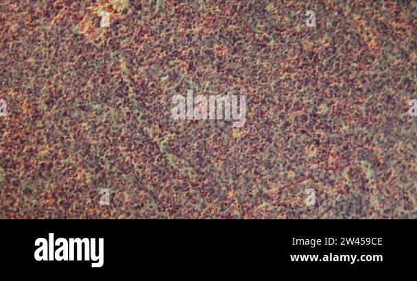 Liver after gas burn infection greatly enlarged under the microscope ...