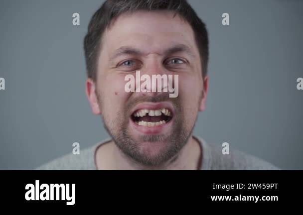 Malocclusion in young Caucasian male, crowded upper teeth. Ugly teeth ...