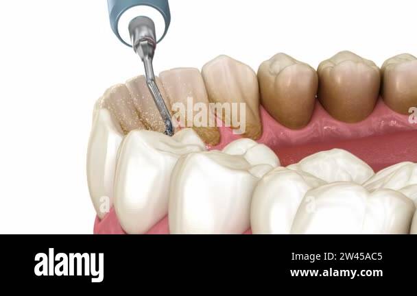 Oral hygiene: Teeth Cleaning Ultrasonic Scaling (conventional ...