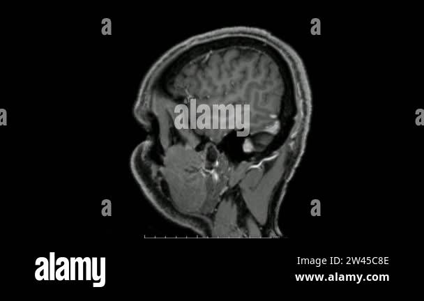 Magnetic resonance images of the brain (MRI brain) sagittal post ...