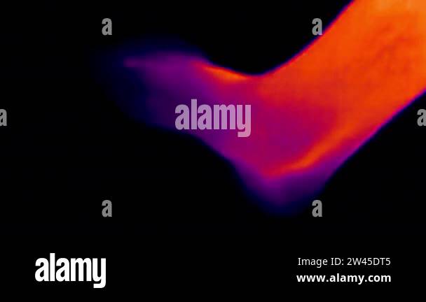 Thermal imaging view of frostbite of the leg. Infrared, thermal, night ...