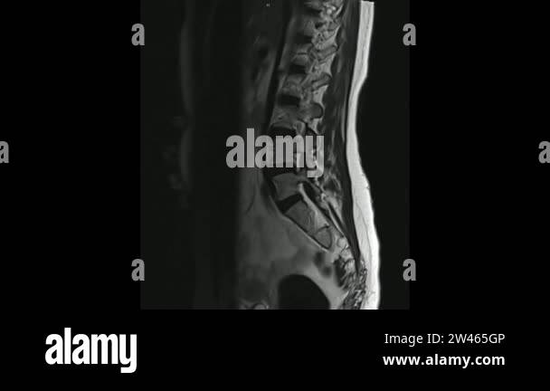 Magnetic Resonance images of Lumbosacral spine sagittal T2-weighted ...