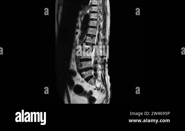 MRI of lumbar spine The study reveals burst fracture of L2 vertebral ...