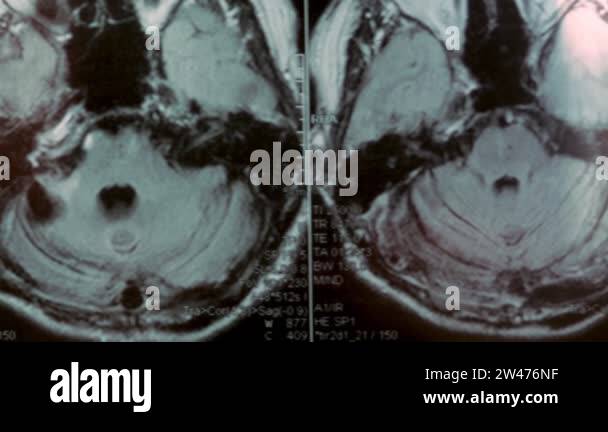 MRI scan of the head. First-person view. The picture shows a large cyst ...