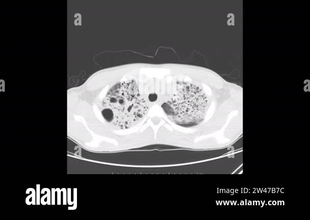 Axial computed Tomography of the chest (lung window) in a known patient of Active pulmonary ...