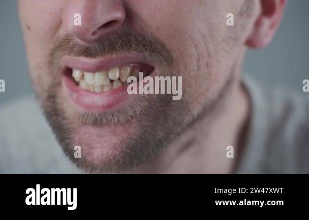 Malocclusion in young Caucasian male, crowded upper teeth. Ugly teeth ...