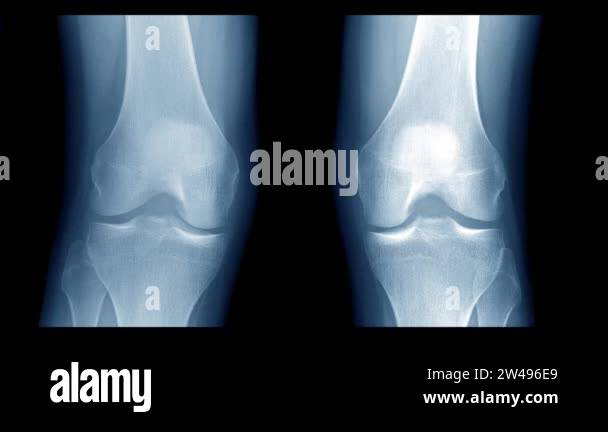 Human knee joints Stock Videos & Footage - HD and 4K Video Clips - Alamy