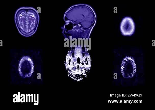 Time lapse of MRI brain scan set, timelapse magnetic resonance imaging ...