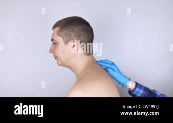 Kyphosis. The man suffers from a curvature of the spine in the upper ...
