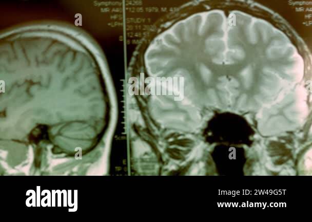MRI scan of the head. First-person view. The picture shows a large cyst ...