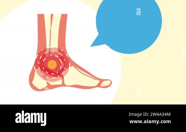 ankle pain rheumatology disease animation Stock Video Footage - Alamy