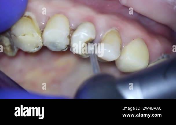 dentistry. shooting with a microscope. necrectomy. the dentist removes ...