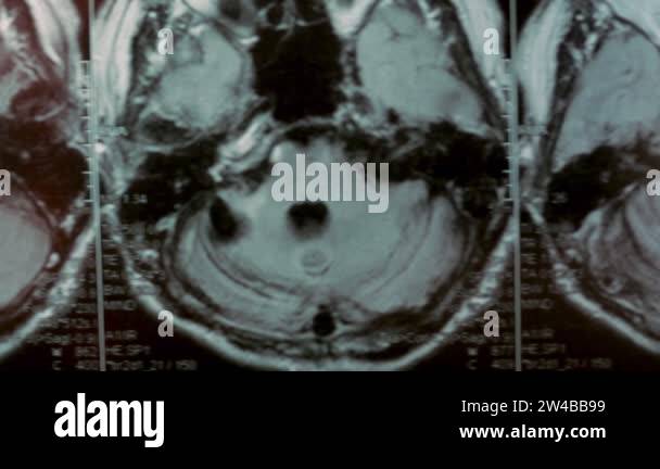 MRI scan of the head. First-person view. The picture shows a large cyst ...