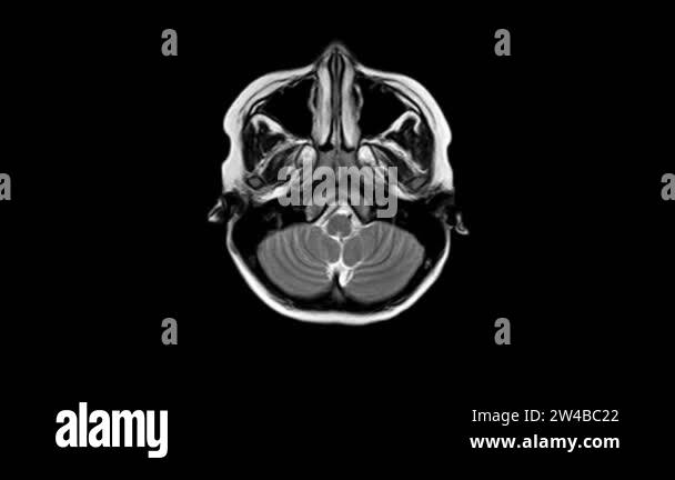 Closeup of a CT scan with brain. Medical, science and education mri ...