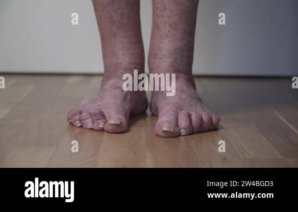 Sore toenails closeup unrecognizable person, old man. A poor womans ...