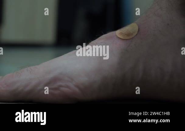 Festering Stock Videos & Footage - HD and 4K Video Clips - Alamy