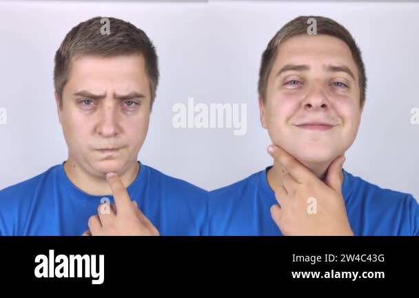Second chin lift in man. Photos before and after plastic surgery ...