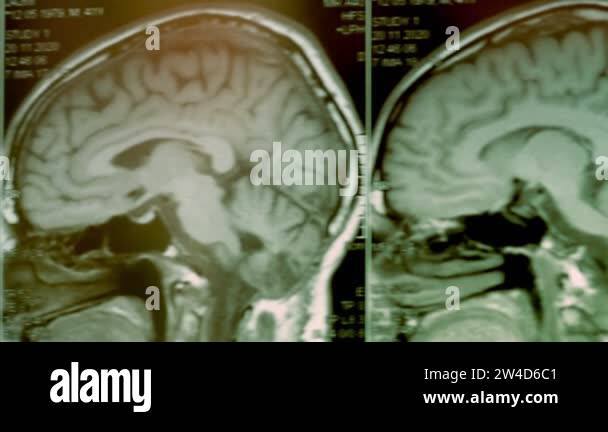 First mri Stock Videos & Footage - HD and 4K Video Clips - Alamy