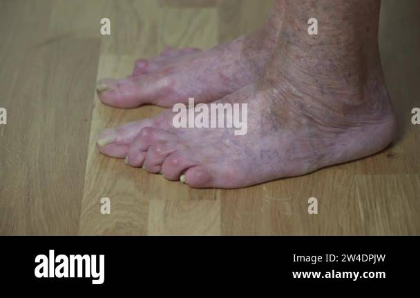 Sick elderly leg. Senior leg problems. Legs old woman with crippled ...
