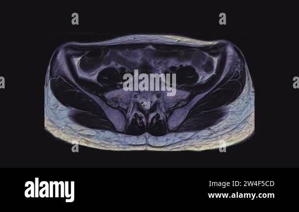 Bulk multicolored MRI of the female pelvic organs, abdominal cavity ...