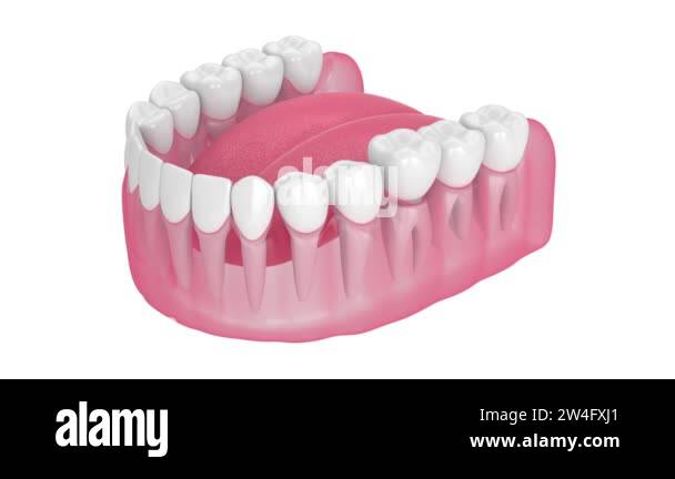 Jaw with dental crown embed on reshaped tooth over transparent ...
