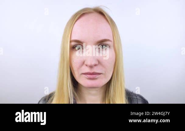 The yellow color of the woman eye. Symptom of jaundice, hepatitis or ...