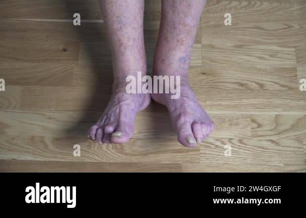 Sore toenails closeup unrecognizable person, old man. A poor womans ...